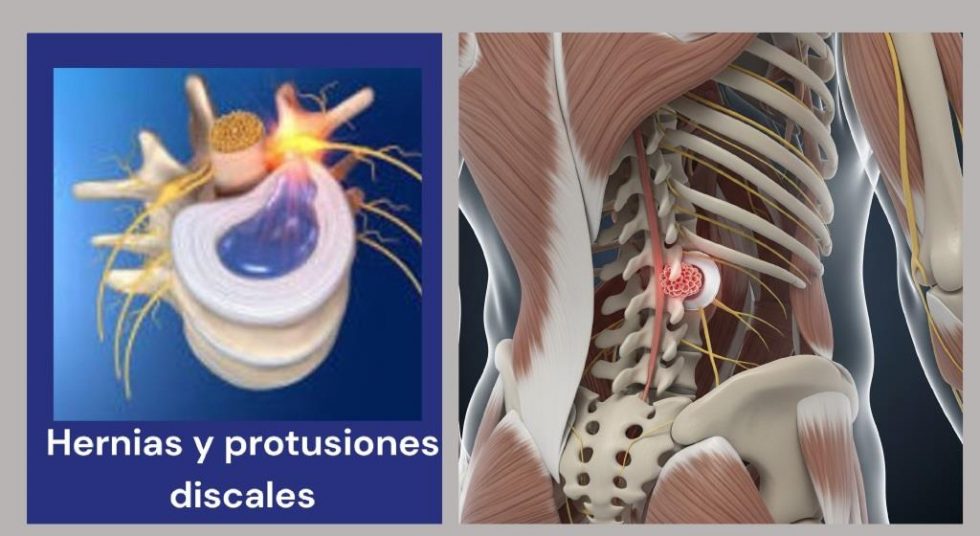 hernias_y_protusiones_discales | Javier de la Nuez
